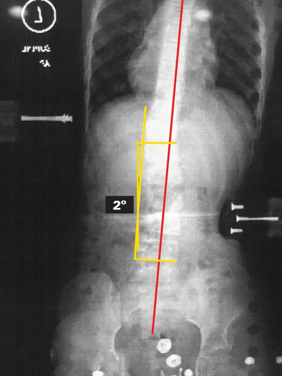 Spinal Technology | The Providence® Brace Overview for Patients