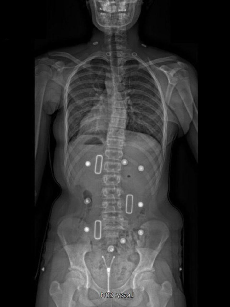 Spinal Technology | SCT 3D Chêneau (Style) Scoliosis Brace