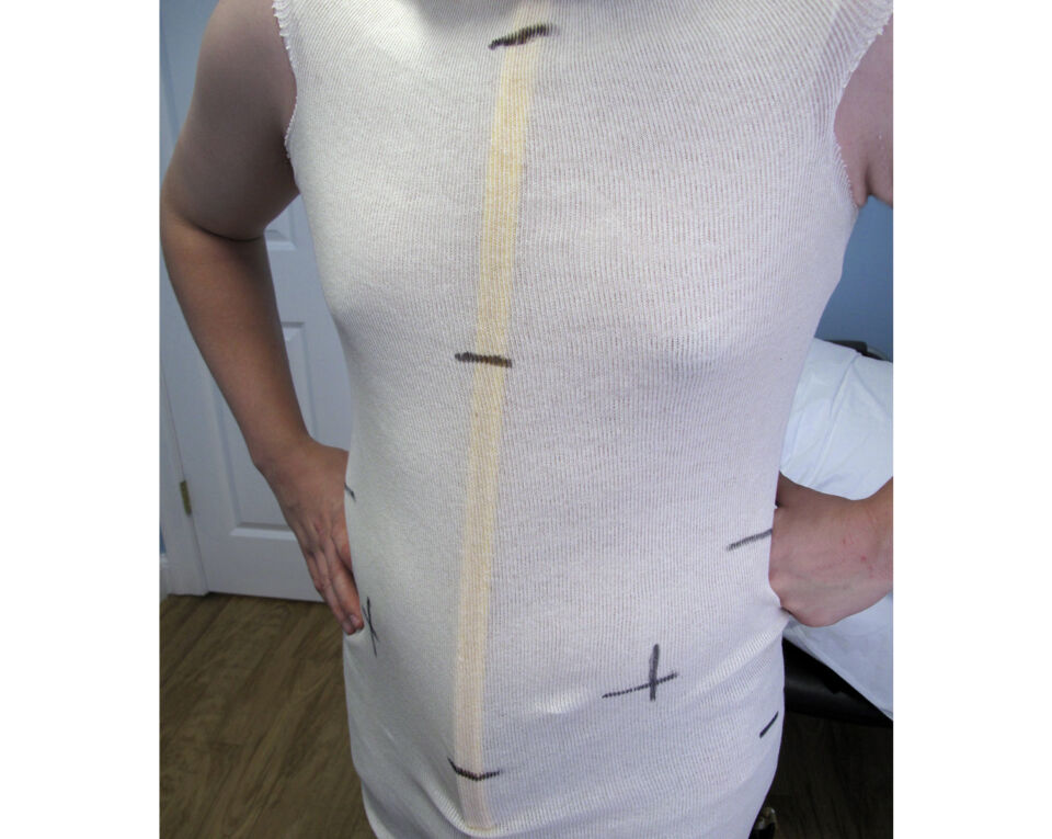 Spinal Technology | Providence® Orthosis Casting Procedure