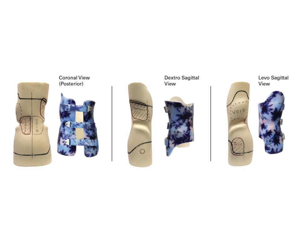 Spinal Technology | Principles of 3D Bracing – Modifications and…