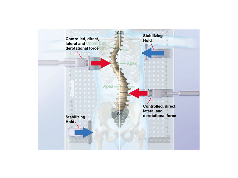 Spinal Technology | Hyper–Correction Forces and The Providence…