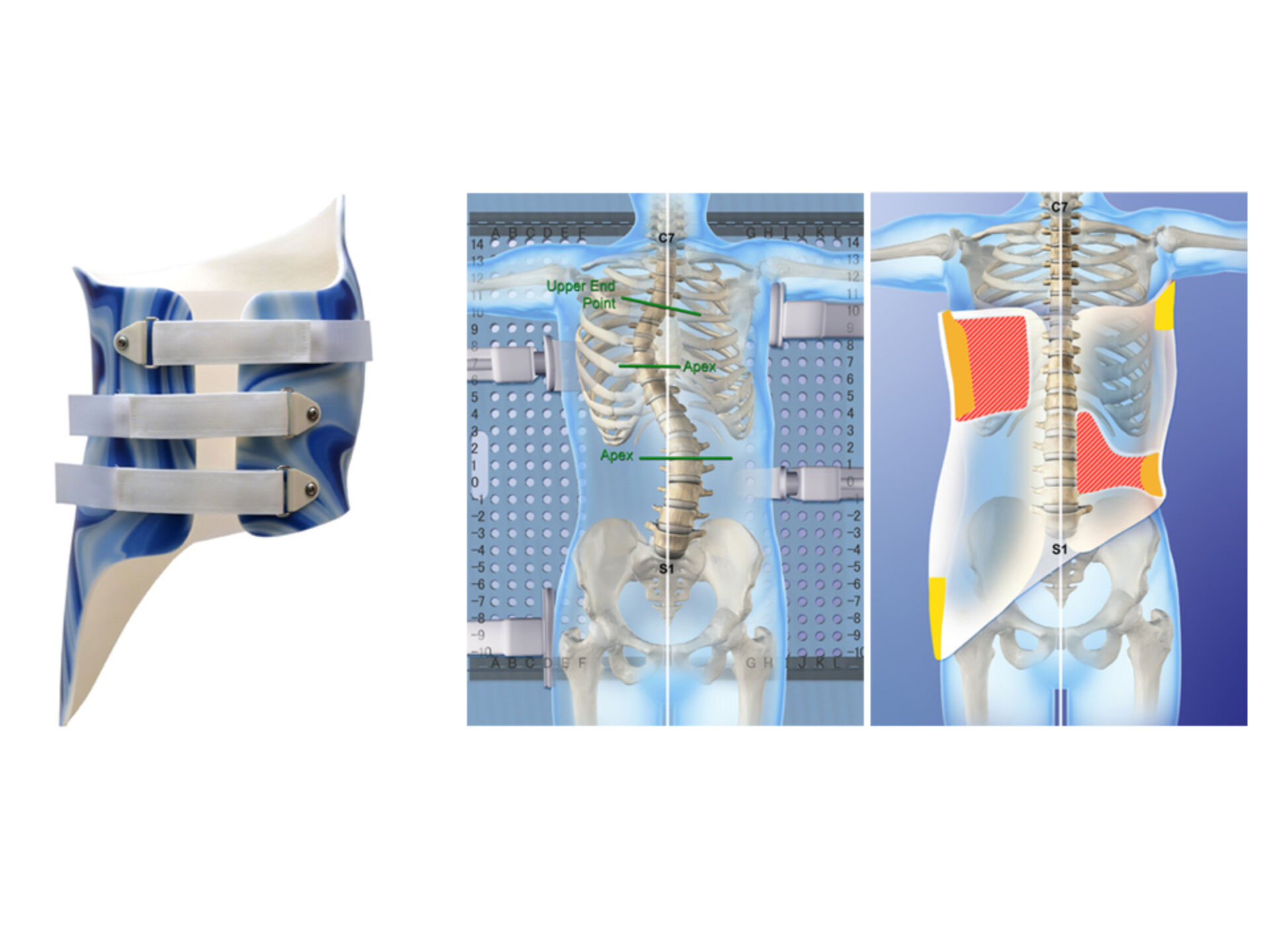 Spinal Technology | Hyper–Correction Forces and The Providence…