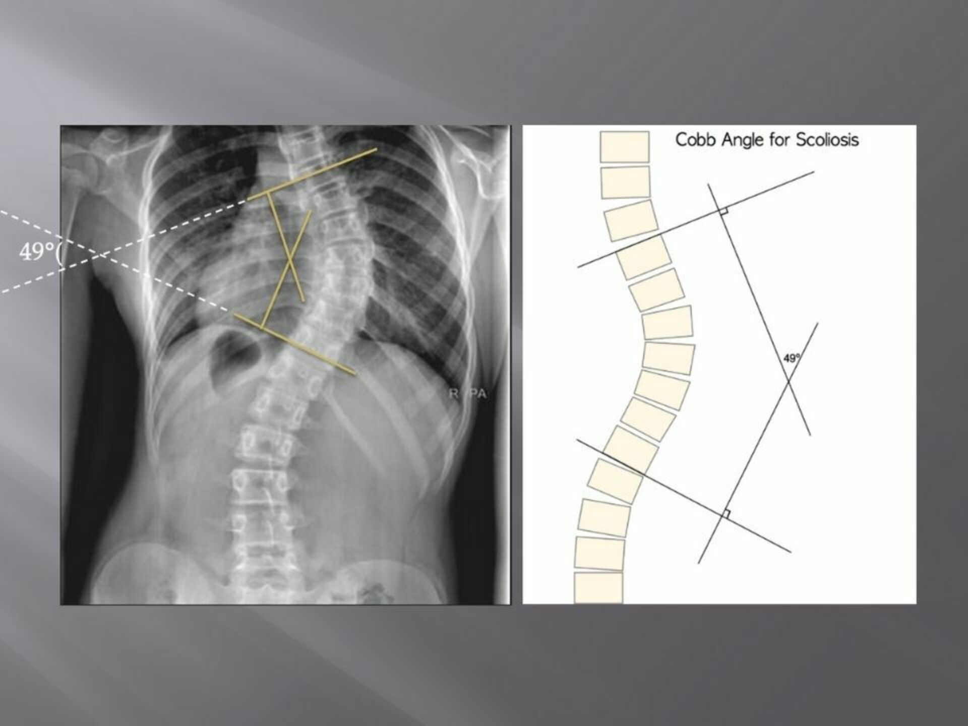 Spinal Technology | Les différents noms des courbes de scoliose