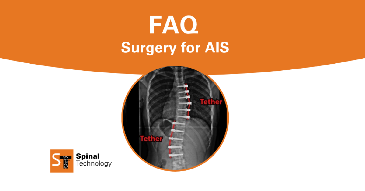 Spinal Technology | An AIS Patient Guide to Surgery