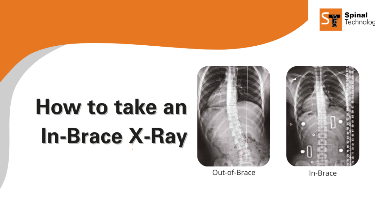 Spinal Technology | Come eseguire una radiografia con apparecchio ...