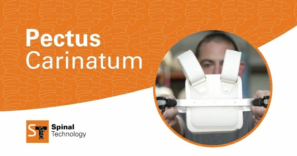 Spinal Technology | Pectus Carinatum Wearing Protocol