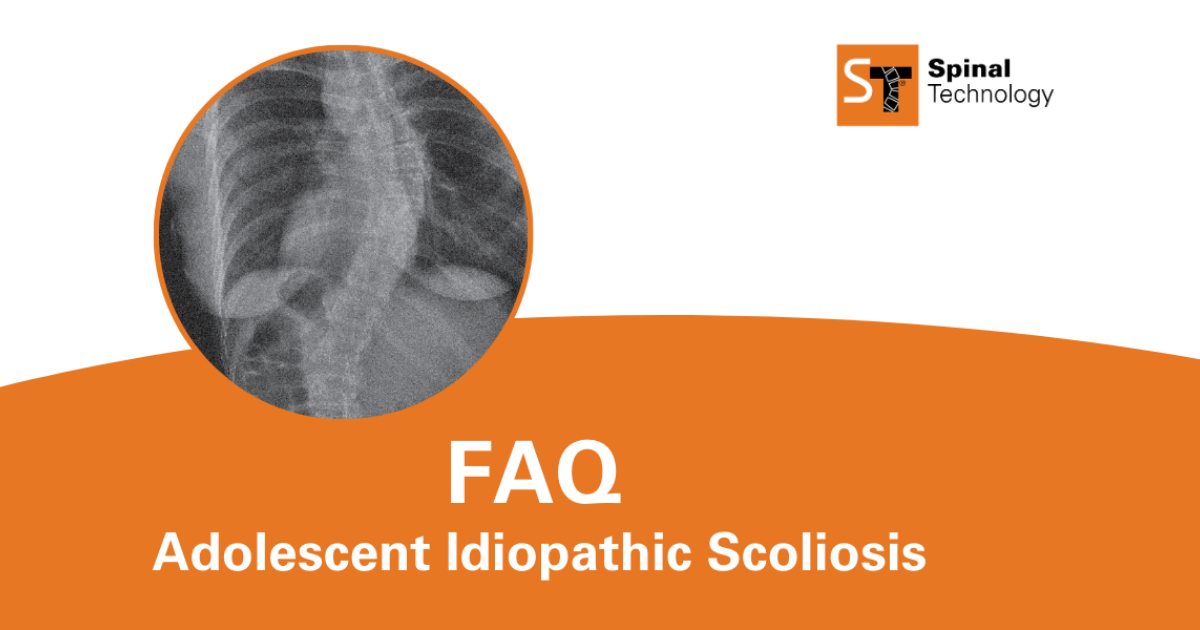 Spinal Technology | A Patient's Guide to Adolescent Idiopathic…